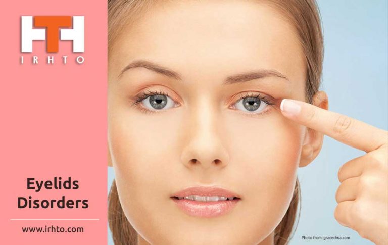 Eyelids Disorders - IRAN Health Tourism Organizer - Iran Medical ...