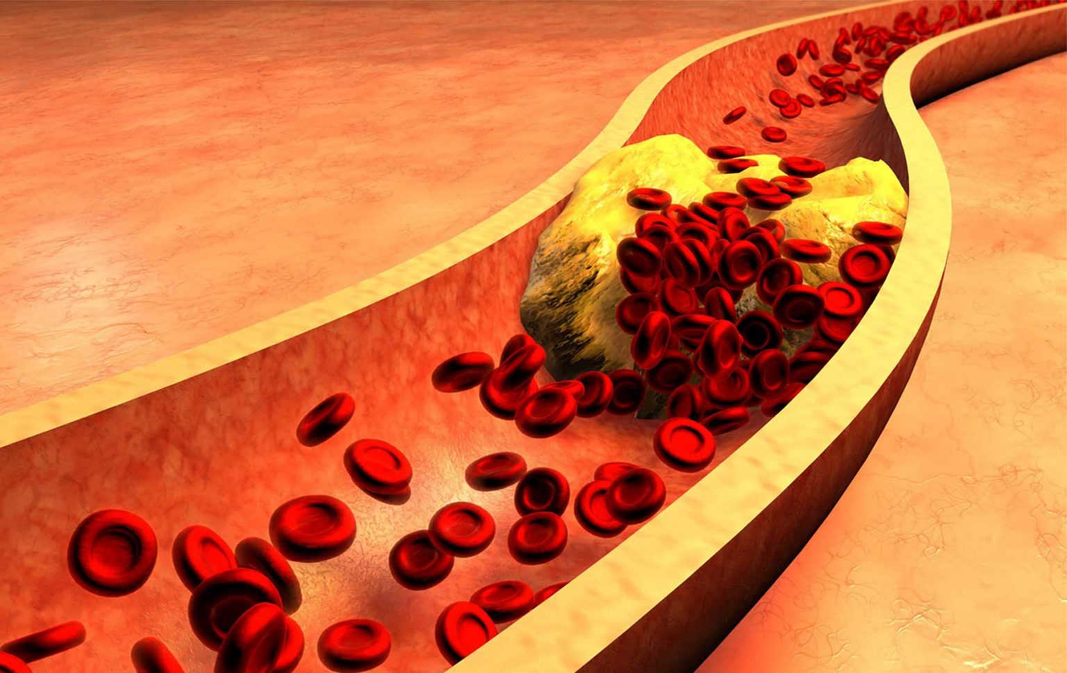 Arterial Embolism - IRAN Health Tourism Organizer - Iran Medical ...