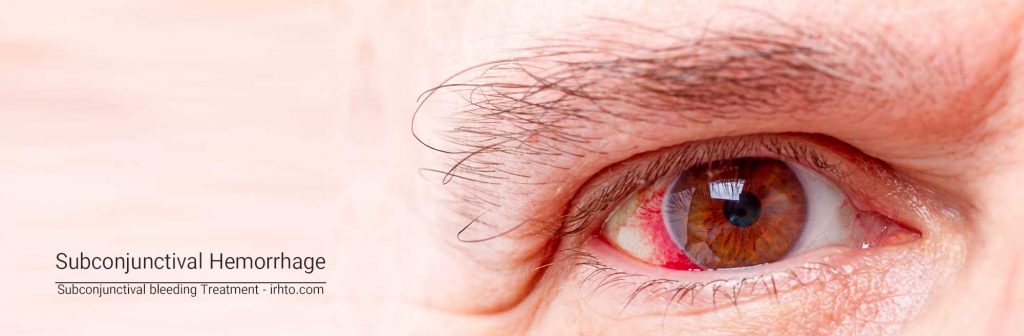 Subconjunctival Hemorrhage - IRAN Health Tourism Organizer - Iran ...