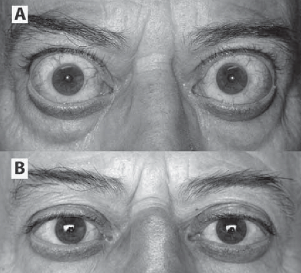 Exophthalmos - IRAN Health Tourism Organizer - Iran Medical Tourism - IRHTO